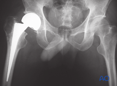 Hemiarthroplasty for Femoral neck and head fractures with hip dislocation