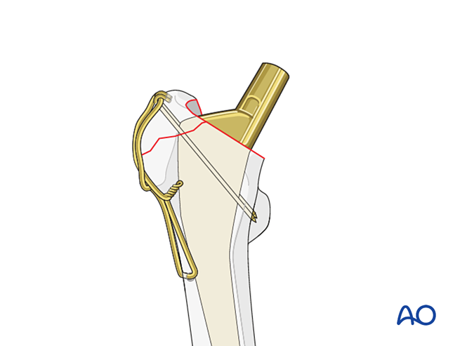 Hemiarthroplasty with reconstruction of greater trochanter for Femoral ...