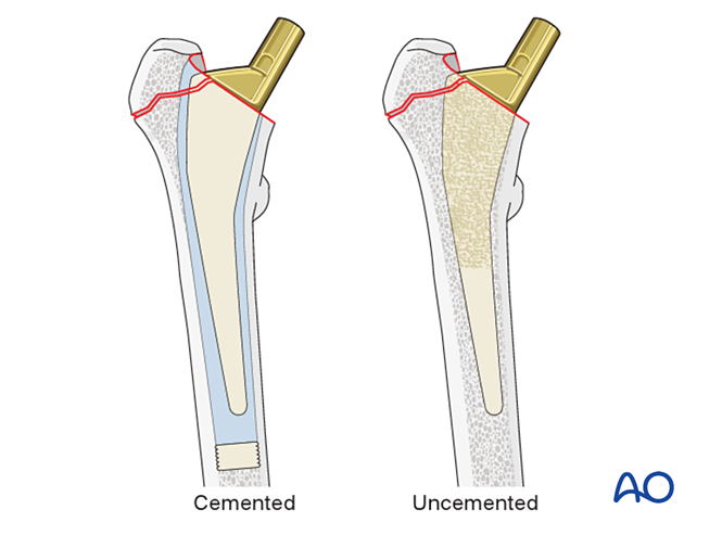 Hemiarthroplasty with reconstruction of greater trochanter for Femoral ...