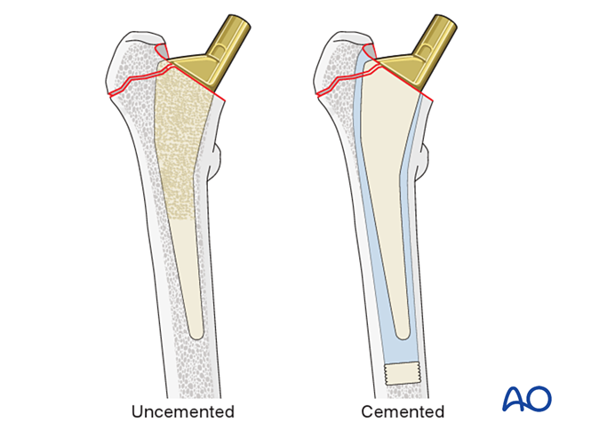 Hemiarthroplasty with reconstruction of greater trochanter for Femoral ...