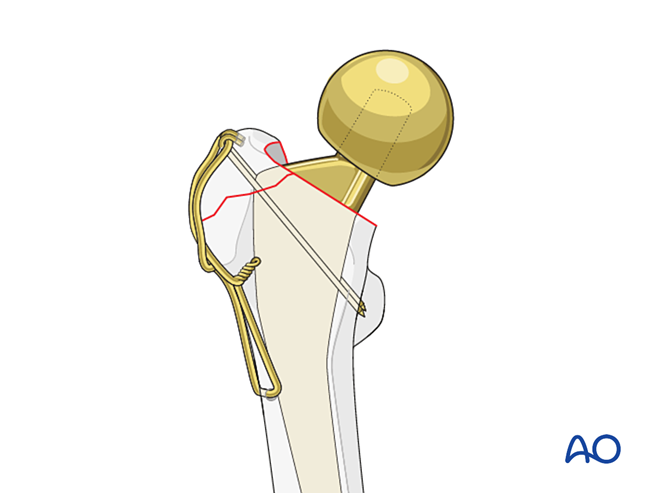 Hemiarthroplasty with reconstruction of greater trochanter for Femoral ...