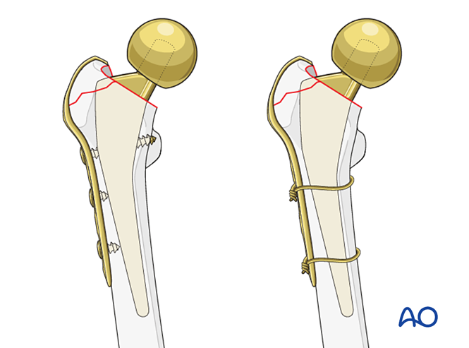 Hemiarthroplasty with reconstruction of greater trochanter for Femoral ...