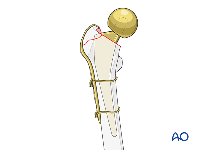 Hemiarthroplasty with reconstruction of greater trochanter for Femoral ...