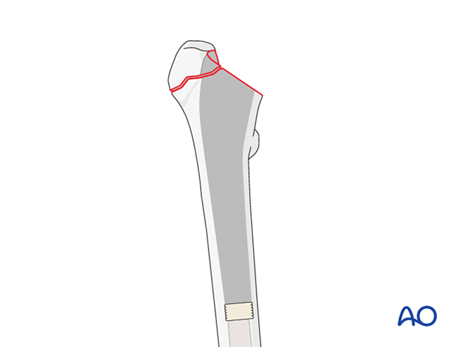 Hemiarthroplasty with reconstruction of greater trochanter for Femoral ...