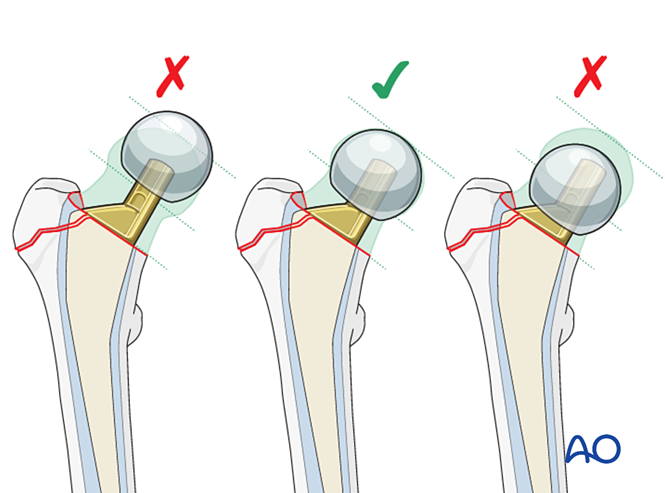 Hemiarthroplasty with reconstruction of greater trochanter for Femoral ...