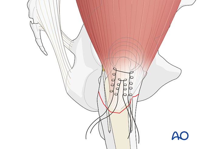 Hemiarthroplasty with reconstruction of greater trochanter for Femoral ...