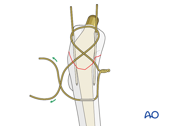 Hemiarthroplasty with reconstruction of greater trochanter for Femoral ...