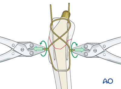 Hemiarthroplasty with reconstruction of greater trochanter for Femoral ...