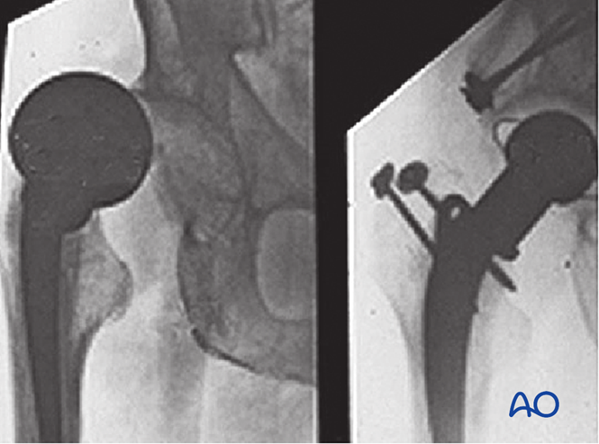 Total hip arthroplasty for Displaced subcapital femoral neck fractures