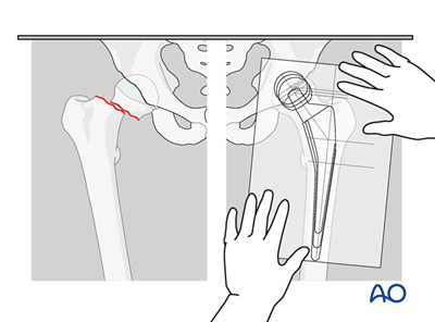 Total hip arthroplasty for Femoral neck and head fractures with hip ...