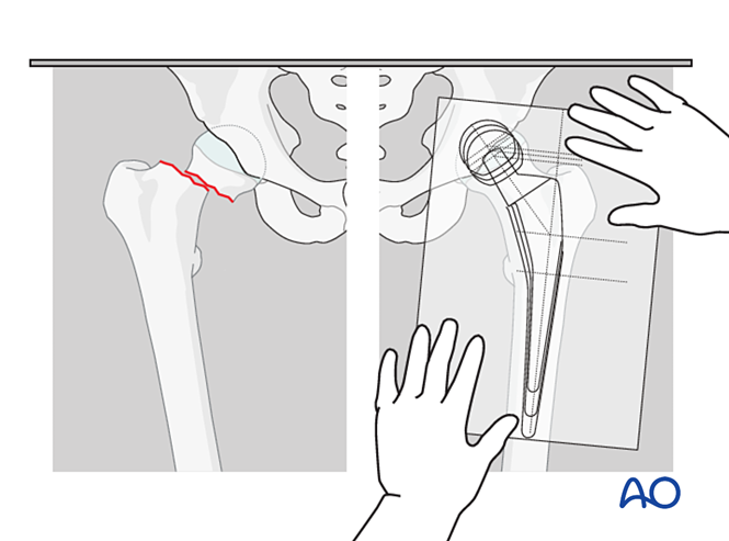 Total hip arthroplasty for Femoral neck and head fractures with hip ...
