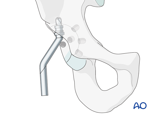 Total hip arthroplasty for Femoral neck and head fractures with hip ...