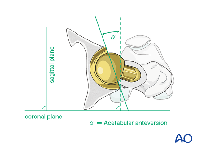 Total hip arthroplasty for Femoral neck and head fractures with hip ...