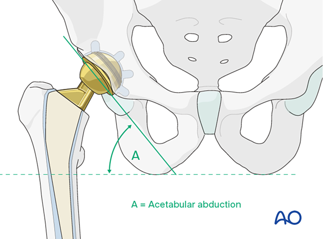 Total hip arthroplasty for Femoral neck and head fractures with hip ...