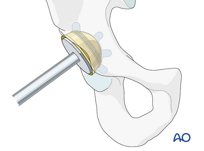 Total hip arthroplasty for Displaced subcapital femoral neck fractures