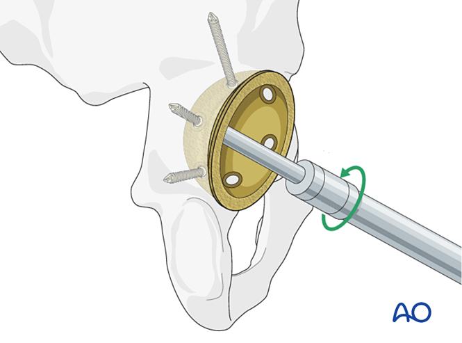 Total hip arthroplasty for Femoral neck and head fractures with hip ...