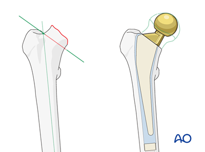 Total hip arthroplasty for Femoral neck and head fractures with hip ...