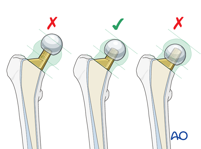 Total hip arthroplasty for Femoral neck and head fractures with hip ...