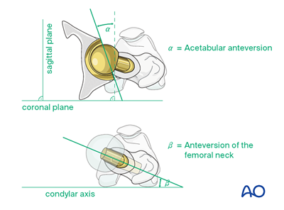 Total hip arthroplasty for Femoral neck and head fractures with hip ...