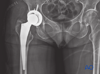 Total hip arthroplasty for Femoral neck and head fractures with hip ...