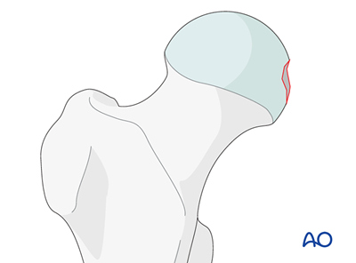Excision for Split fractures of the femoral head