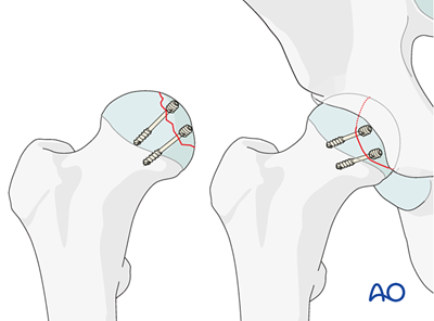 ORIF - Mini-fragment or headless screws for Split fractures of the ...