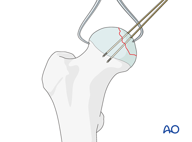 ORIF - Mini-fragment or headless screws for Split fractures of the ...