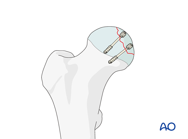 Orif Mini Fragment Or Headless Screws For Split Fractures Of The