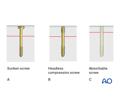 ORIF - Mini-fragment or headless screws for Split fractures of the ...