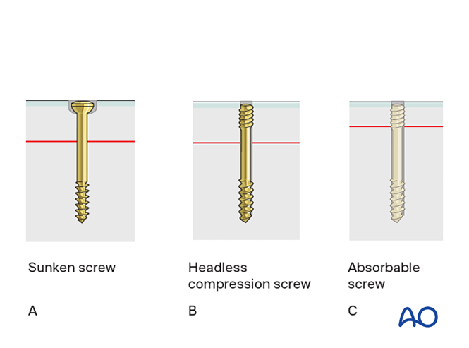 ORIF - Mini-fragment or headless screws for Split fractures of the ...