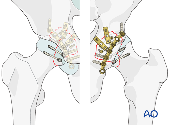 ORIF for Femoral head fractures with posterior wall fracture of the ...