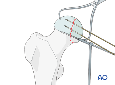 ORIF for Femoral head fractures with posterior wall fracture of the ...