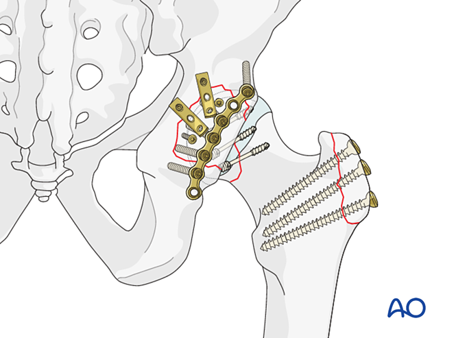ORIF for Femoral head fractures with posterior wall fracture of the ...