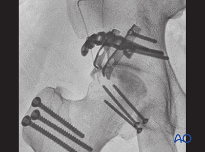 ORIF for Femoral head fractures with posterior wall fracture of the ...