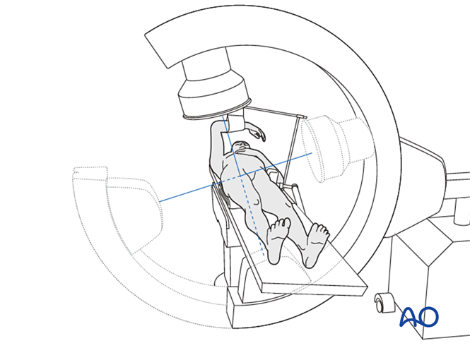 Supine patient position on a radiolucent table