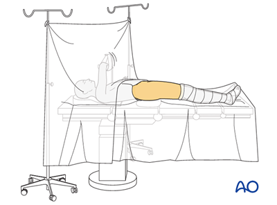 Supine patient position for arthroplasty