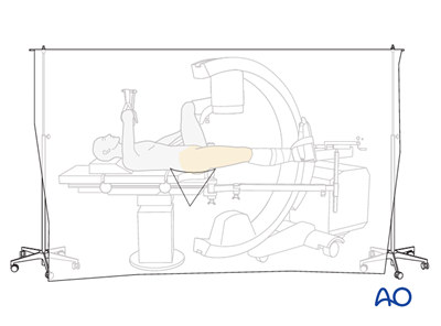 Supine patient position on a fracture table