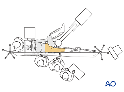 Supine patient position on a fracture table