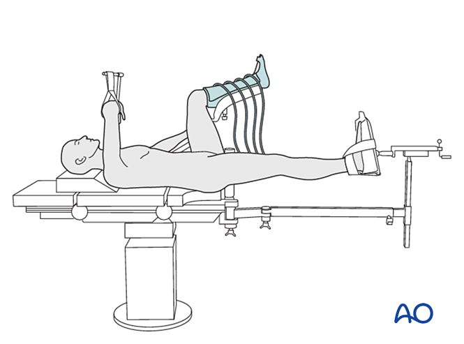 Supine patient position on a fracture table