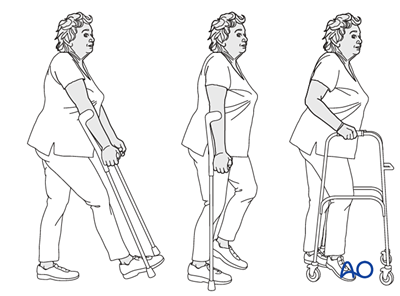 Nailing (short nail) for Intertrochanteric fractures