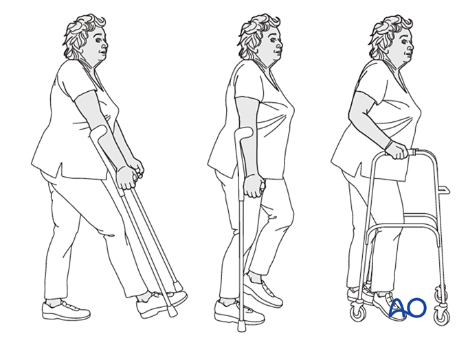 Nonoperative treatment for Split fractures of the femoral head