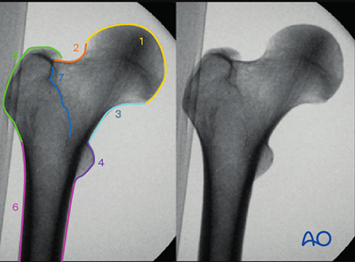 Intraoperative imaging of the proximal femur