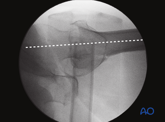 Intraoperative imaging of the proximal femur
