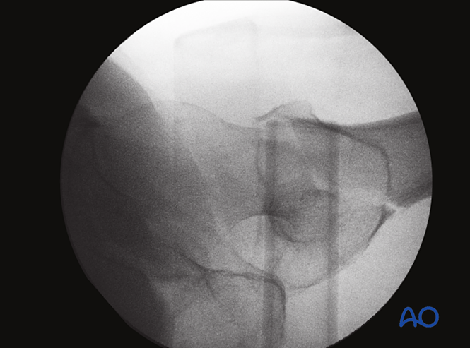 Intraoperative imaging of the proximal femur