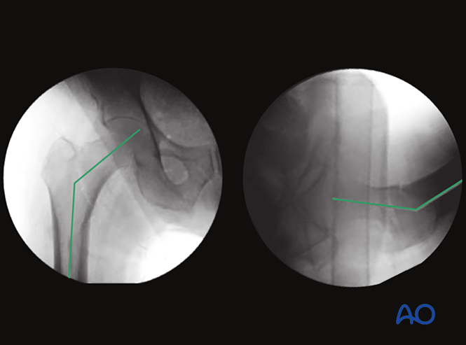 Intraoperative imaging of the proximal femur
