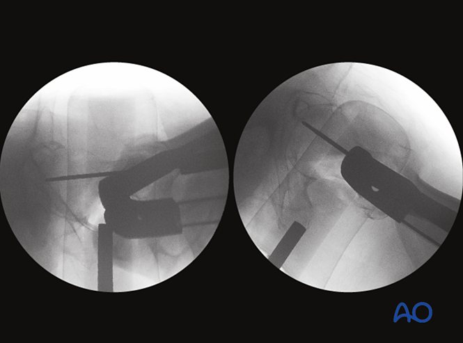Intraoperative imaging of the proximal femur