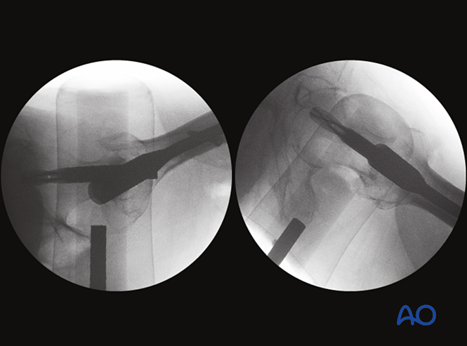 Intraoperative imaging of the proximal femur
