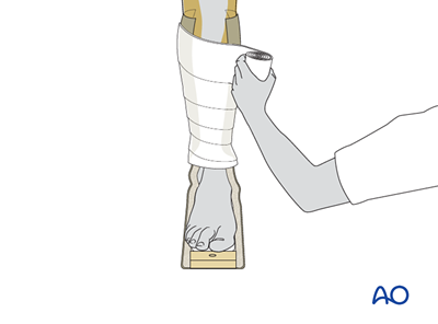 Fracture management with minimal resources for Basicervical femoral ...