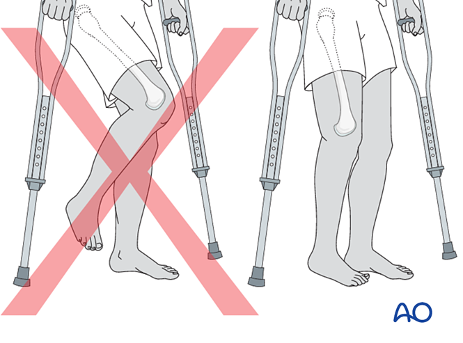Fracture management with minimal resources for Femoral neck and head ...