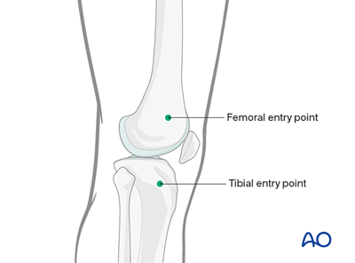 Fracture management with minimal resources for Impacted or nondisplaced ...
